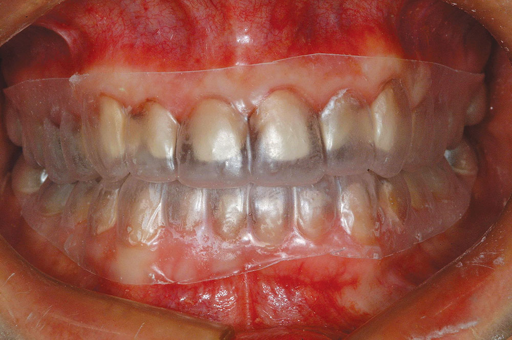 Prosthetic Tooth Repositioning: A Viable Treatment Option for Select Cases