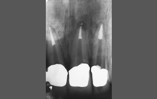 Photo Essay: Post-and-Core Technique with BioTemps® Provisionals