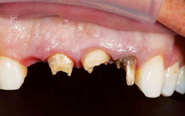 Photo Essay: Post-and-Core Technique with BioTemps® Provisionals