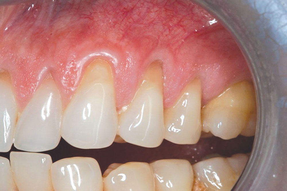 The Use of Perioderm for Root Coverage and Correction of Insufficient ...