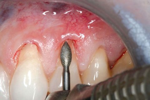 The Use of Perioderm for Root Coverage and Correction of Insufficient ...