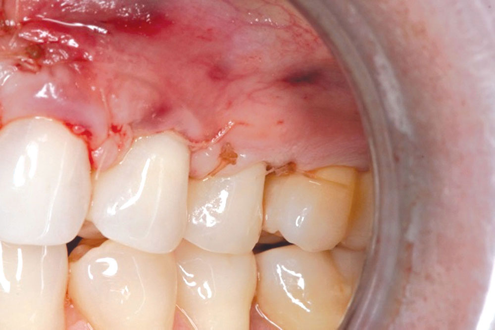 The Use of Perioderm for Root Coverage and Correction of Insufficient ...