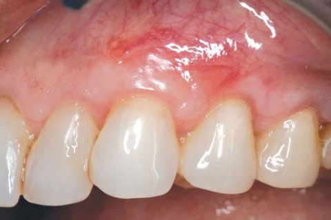 The Use of Perioderm for Root Coverage and Correction of Insufficient ...