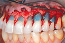 The Use of Perioderm for Root Coverage and Correction of Insufficient ...