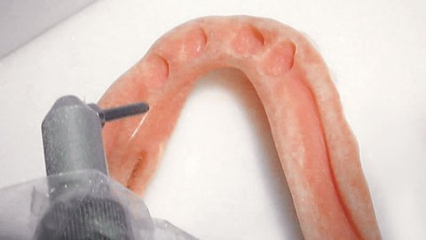 Achieving Reliable Denture Stability: The Need for Implant-Retained ...