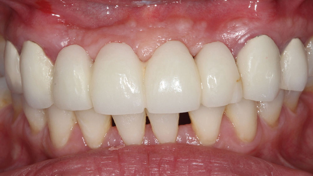 Utilizing a Digital Workflow for Provisionalization with BioTemps