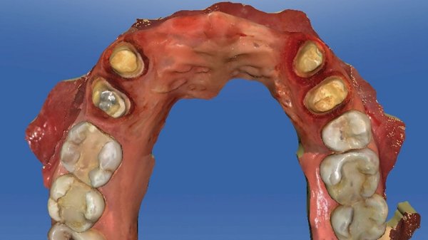 Utilizing a Digital Workflow for Provisionalization with BioTemps