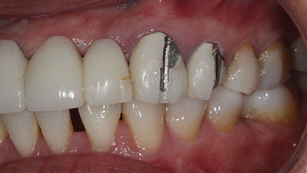 Utilizing a Digital Workflow for Provisionalization with BioTemps