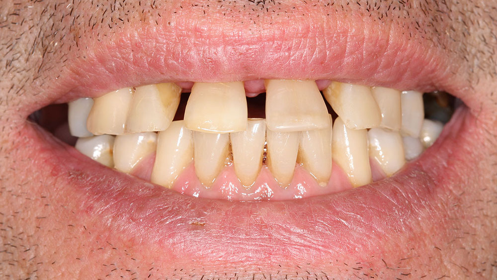 Advanced Treatment Planning: One Recipe for Implant Success