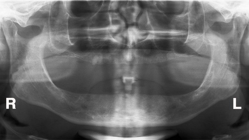 A Better Quality of Life with Implant-Retained Overdentures
