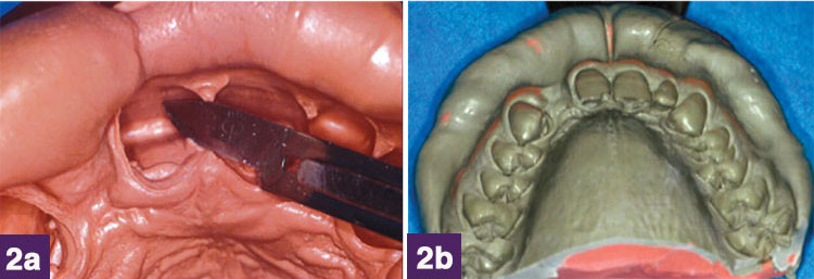 The Hydraulic & Hydrophobic Impression Technique: Facts Based on the ...