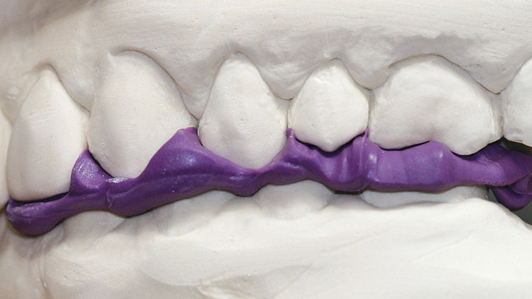 The Hydraulic & Hydrophobic Impression Technique: Facts Based on the ...