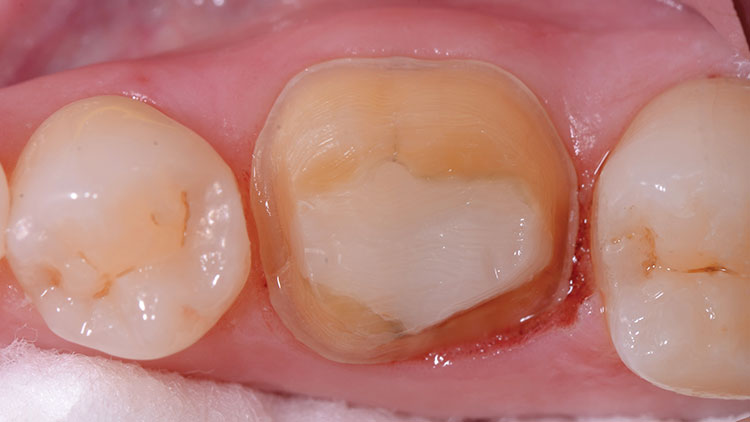 Tooth in a Bag: Same-Day Monolithic Zirconia Crown