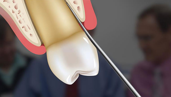 Extraction and Socket Grafting: Part 1 — Atraumatic Extraction