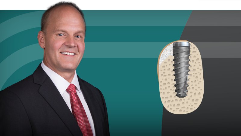 Guided Bone Regeneration: 8 Steps to Successful Ridge Augmentation