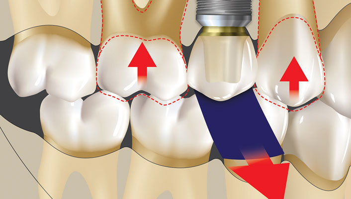 Principles of Implant Occlusion: Part 2 – Recommendations for Single ...