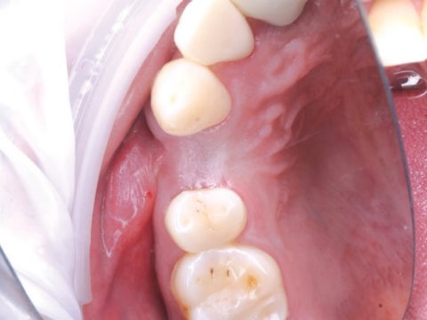 Buccal Roll Technique for Augmentation of Keratinized Tissue
