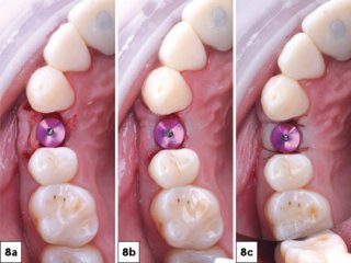 Buccal Roll Technique for Augmentation of Keratinized Tissue