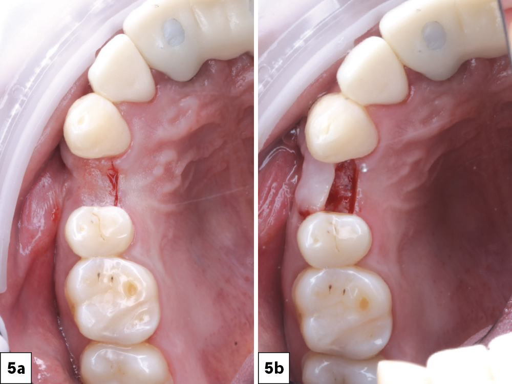 Buccal Roll Technique for Augmentation of Keratinized Tissue