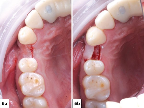 Buccal Roll Technique for Augmentation of Keratinized Tissue