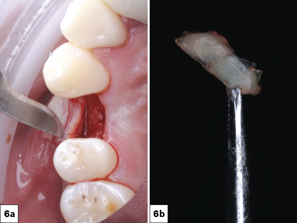 Buccal Roll Technique for Augmentation of Keratinized Tissue