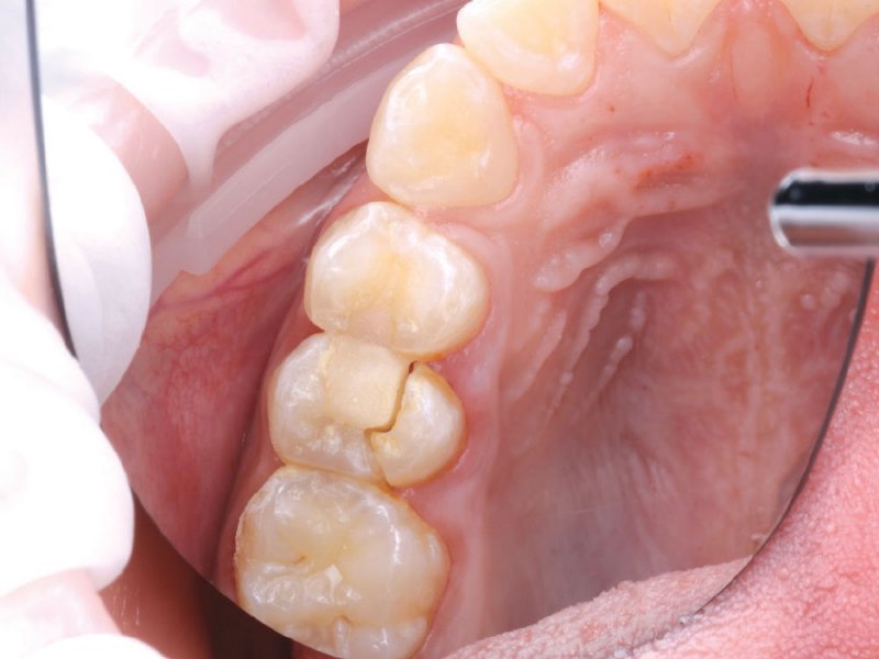 Buccal Roll Technique for Augmentation of Keratinized Tissue
