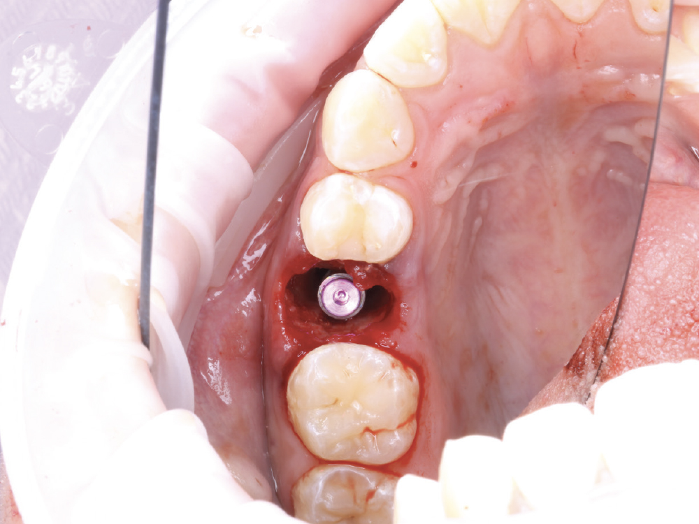 Buccal Roll Technique for Augmentation of Keratinized Tissue