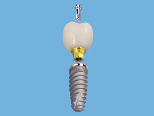 Implant Restorations: Screw-Retained vs. Cemented Crowns