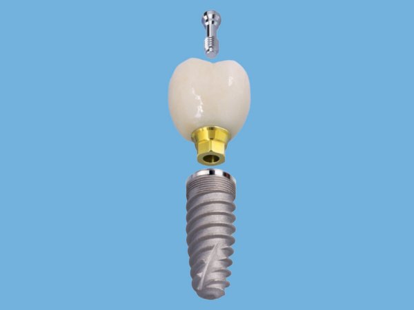 Implant Restorations: Screw-Retained vs. Cemented Crowns