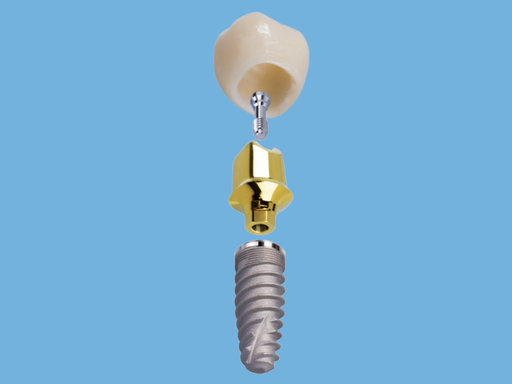 Implant Restorations: Screw-Retained vs. Cemented Crowns