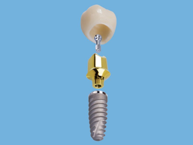 Implant Restorations: Screw-Retained vs. Cemented Crowns