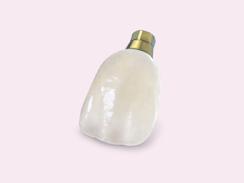 Product Spotlight | Screw-Retained Crowns