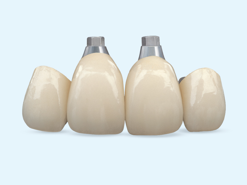 Product Spotlight | Screw-Retained Crowns