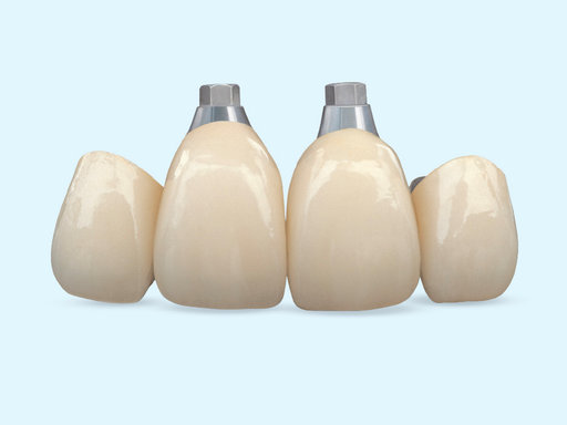 Product Spotlight | Screw-Retained Crowns