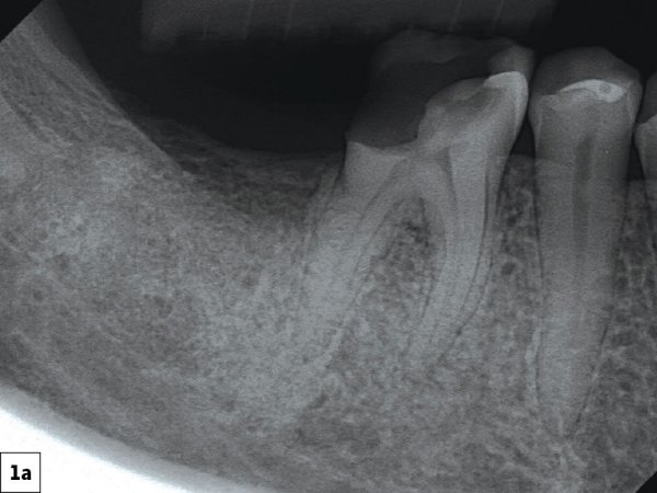 Selecting Grafting Materials Based on the Anatomical Defect