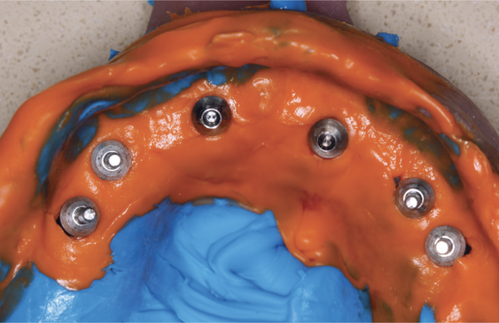 BruxZir® Implant Prosthesis vs. Acrylic Hybrids