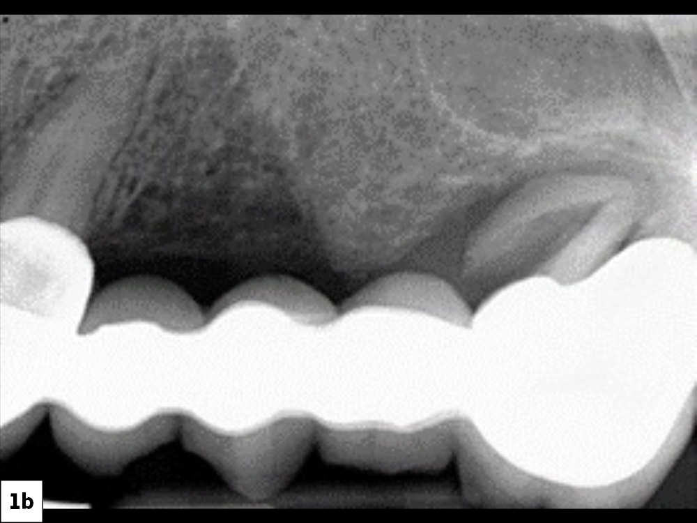 Tilted Implants in the Partially Edentulous Maxilla