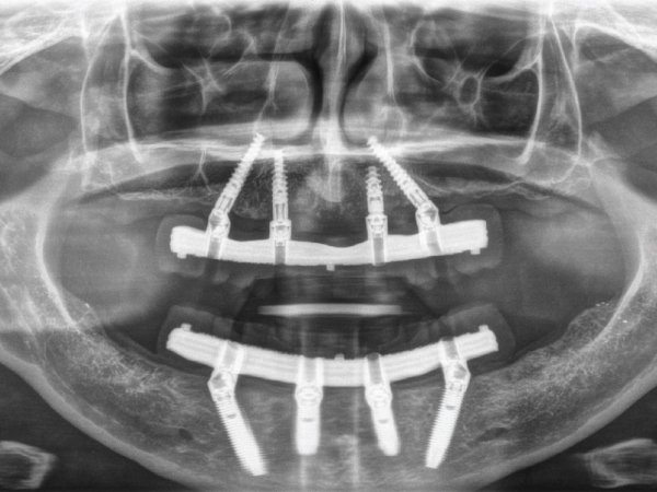 Full-Arch Fixed Restoration: New Option Guide