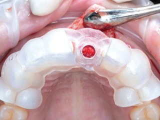 Dental Implant Surgical Guide: How To Choose The Right One