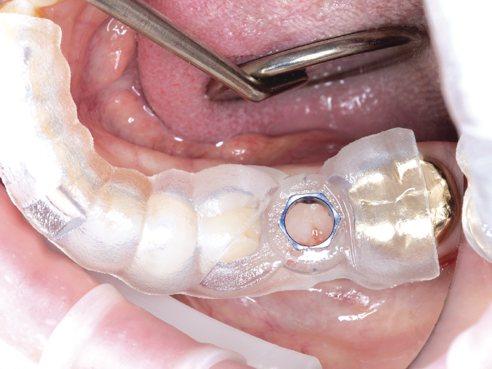 Dental Implant Surgical Guide: How To Choose The Right One
