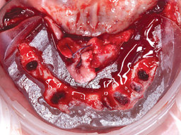 Dental Implant Surgical Guide: How To Choose The Right One