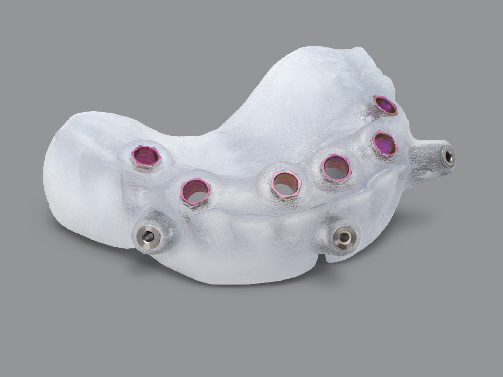 Dental Implant Surgical Guide: How To Choose The Right One