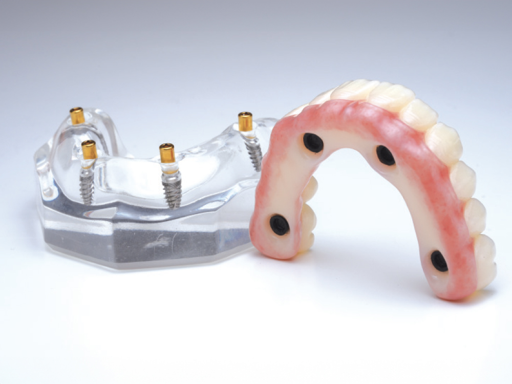 Locator Fixed Prosthesis: Easy Procedure & Esthetics