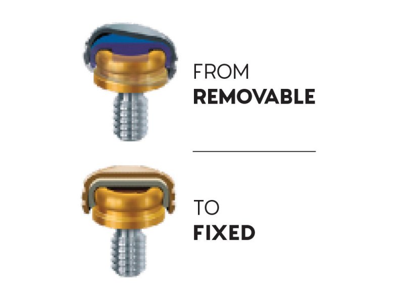 Locator Fixed Prosthesis: Easy Procedure & Esthetics