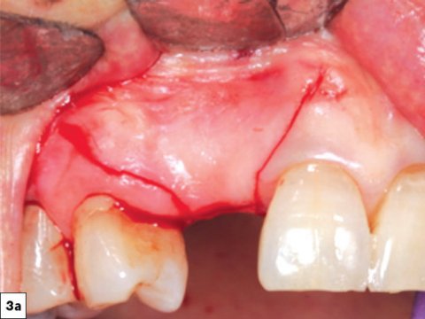 Management of Incision Line Opening for Better Healing