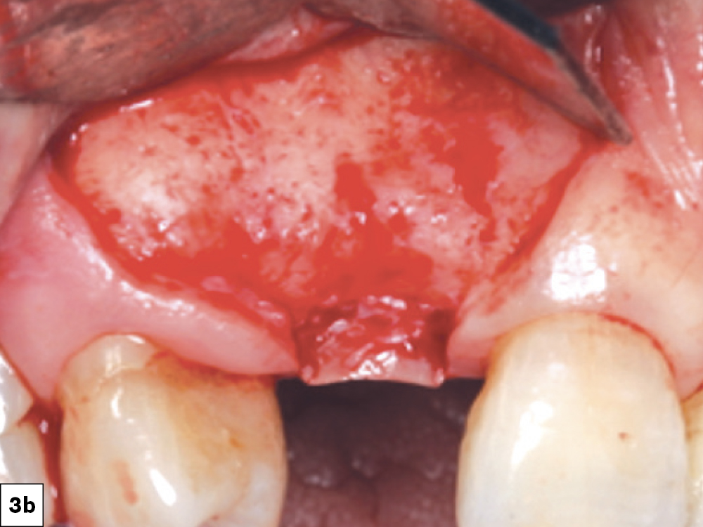 Management of Incision Line Opening for Better Healing