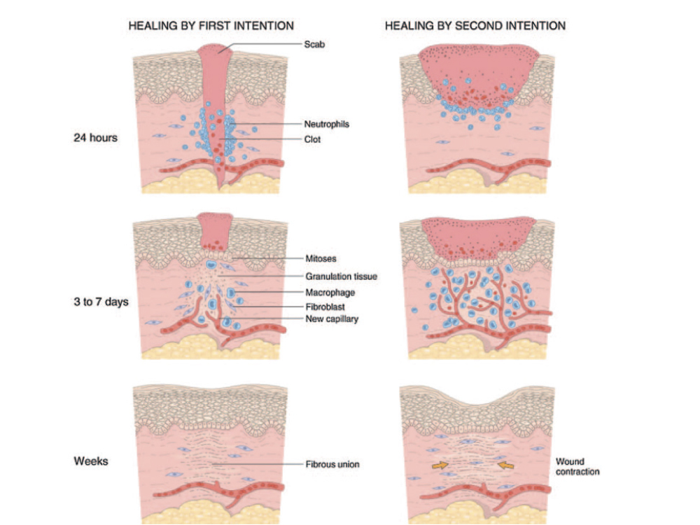 Management of Incision Line Opening for Better Healing