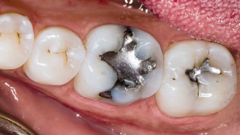 Full-Cast Gold Crowns - Full-Cast Restorations - Glidewell