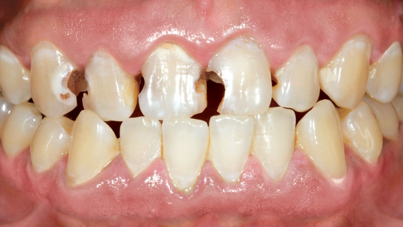 IPS e.max is an alternative to zirconia-based restorations
