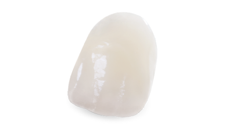 IPS e.max is an alternative to zirconia-based restorations